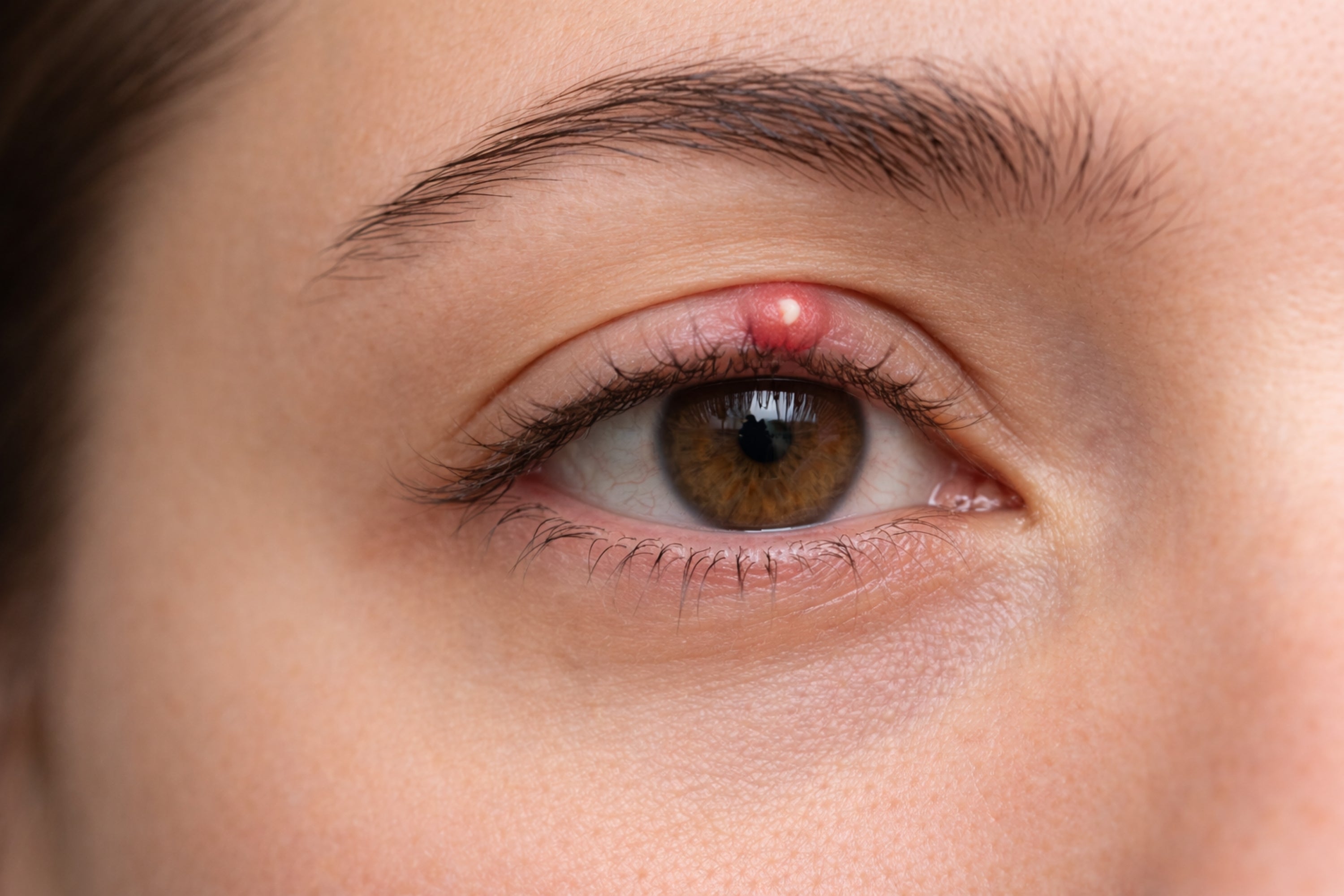 Recognise A Stye | Symptoms, Causes & Treatment Explained – Leightons