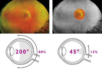Optomap Eye Examination – Leightons