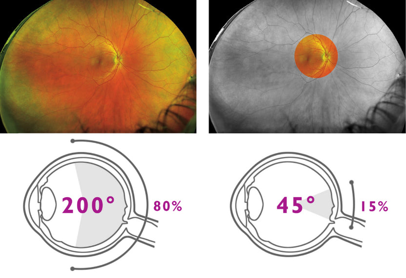 Optomap Eye Examination – Leightons