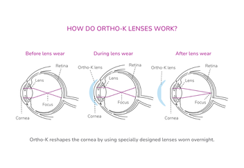 Ortho K Contact Lenses | Lens For Orthokeratology – Leightons