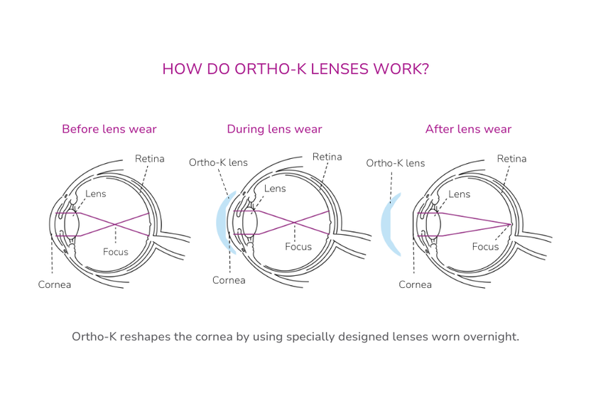 Ortho K Contact Lenses | Lens For Orthokeratology – Leightons